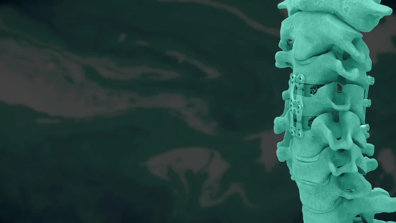 NuVasive on LinkedIn: Hear from Dr. Reg Haid from Atlanta Brain and ... NuVasive on LinkedIn: Hear from Dr. Reg Haid from Atlanta Brain and ...