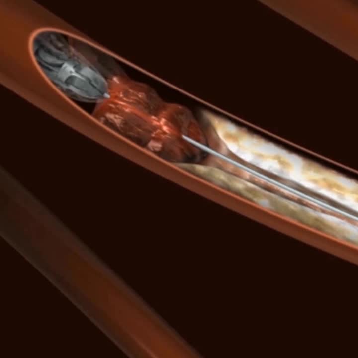 Jon Steinberg on LinkedIn: This drill clears your artery wall by ... Jon Steinberg on LinkedIn: This drill clears your artery wall by ...
