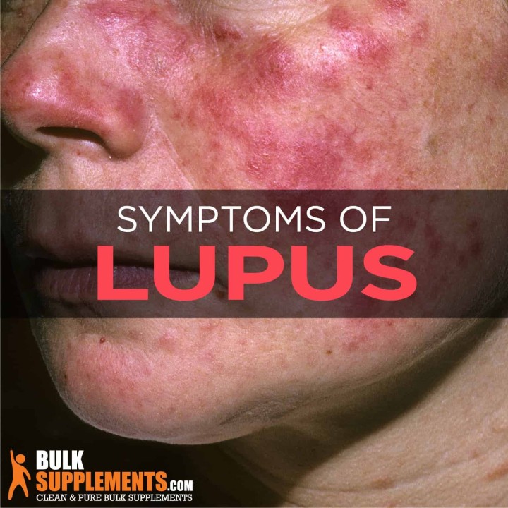 Lupus: Causes, Symptoms & Treatment Lupus: Causes, Symptoms & Treatment