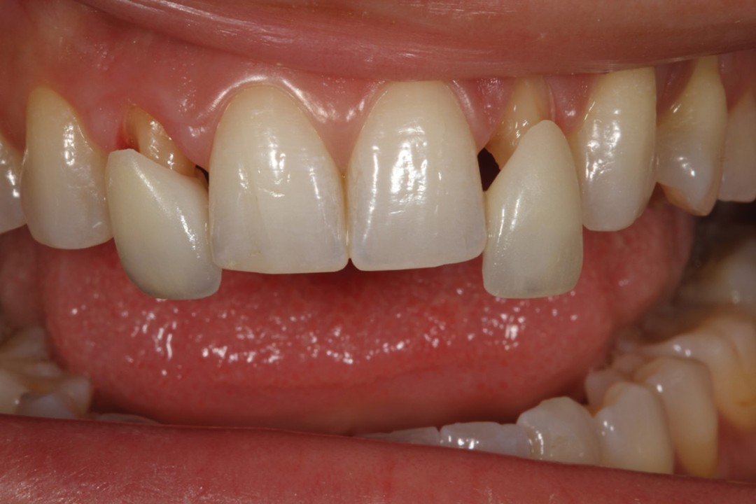 Maximum Custom Shade Matching for Laterals Maximum Custom Shade Matching for Laterals