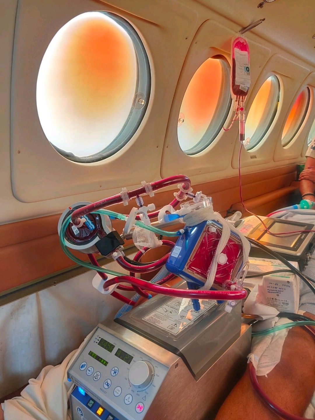 Dr Ruchi Yadav on LinkedIn: #ecmo Dr Ruchi Yadav on LinkedIn: #ecmo
