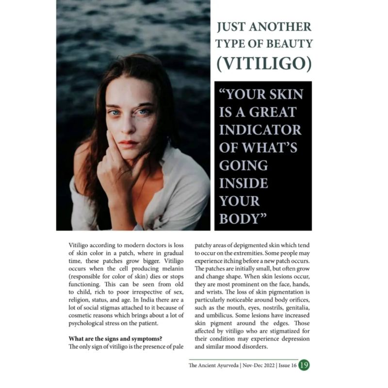 Dr.Pragati Singh on LinkedIn: vitiligo and ayurveda ️ Dr.Pragati Singh on LinkedIn: vitiligo and ayurveda ️