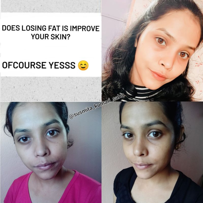 Susmita Kumari Sahu on LinkedIn: #skintransformation #consistency Susmita Kumari Sahu on LinkedIn: #skintransformation #consistency