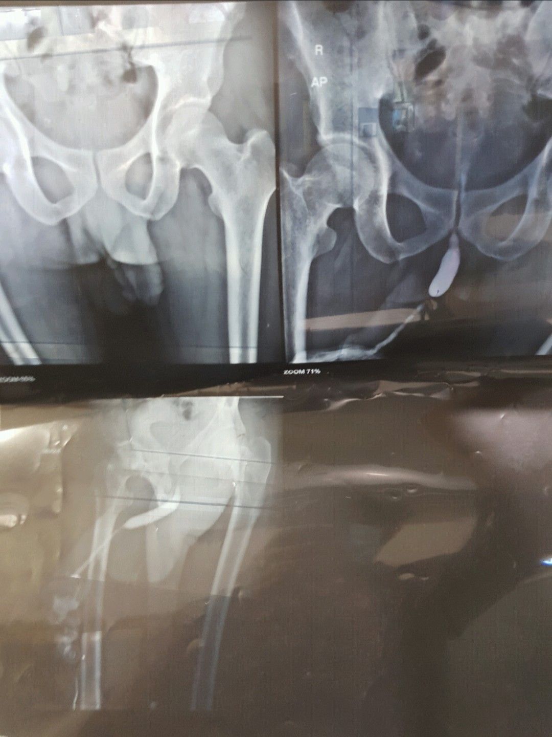 Waqar Hafeez on LinkedIn: Retrograde urethrogram showing urethral ... Waqar Hafeez on LinkedIn: Retrograde urethrogram showing urethral ...