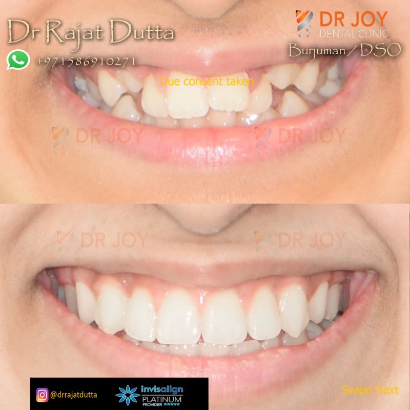 Dr Rajat Dutta on LinkedIn: #malocclusion #teethalignment #braces # ... Dr Rajat Dutta on LinkedIn: #malocclusion #teethalignment #braces # ...