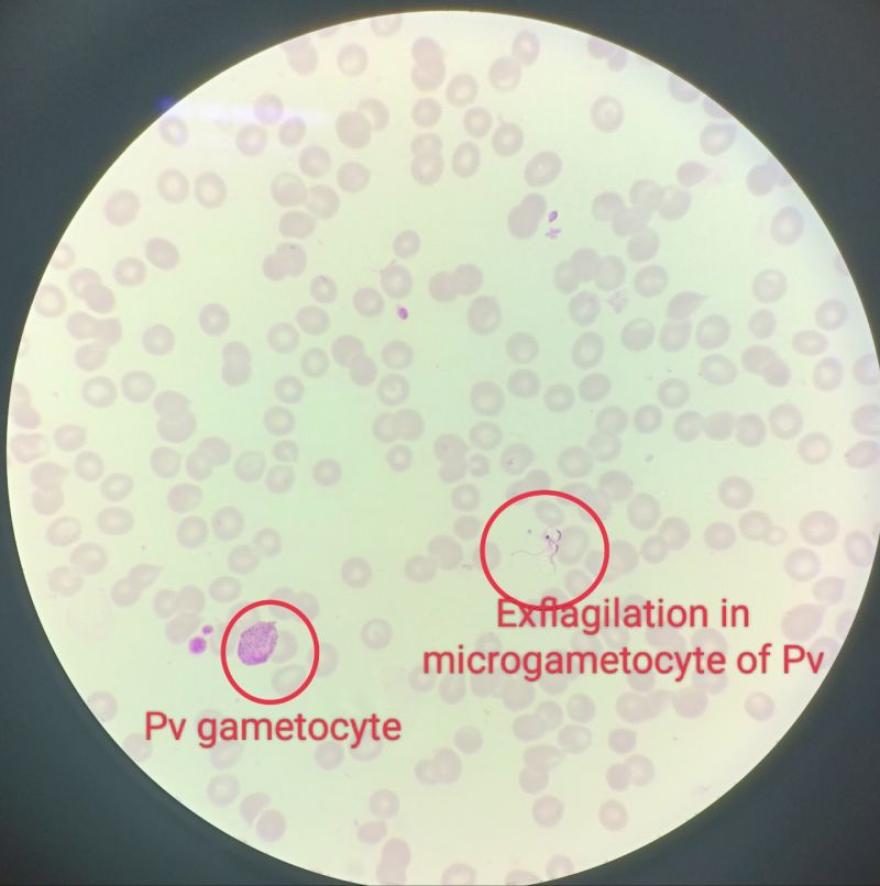 Naseem Ahmed on LinkedIn: #malaria #diagnosis #microscopy # ... Naseem Ahmed on LinkedIn: #malaria #diagnosis #microscopy # ...