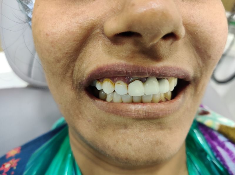 Dr. Urvi Rathod on LinkedIn: #smilemakeover Dr. Urvi Rathod on LinkedIn: #smilemakeover