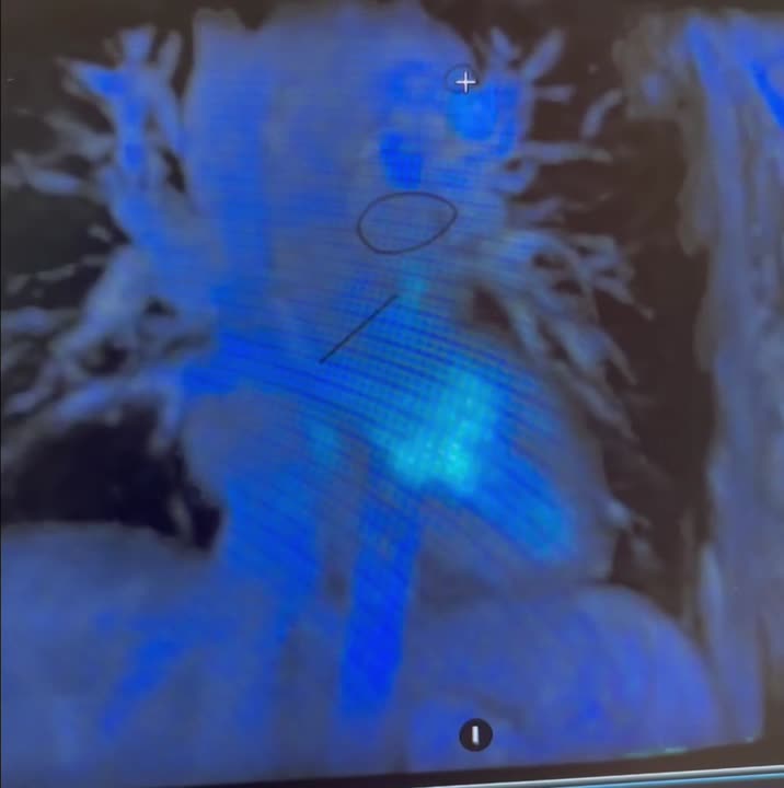 Anurag Sahu on LinkedIn: #achd #mri Anurag Sahu on LinkedIn: #achd #mri