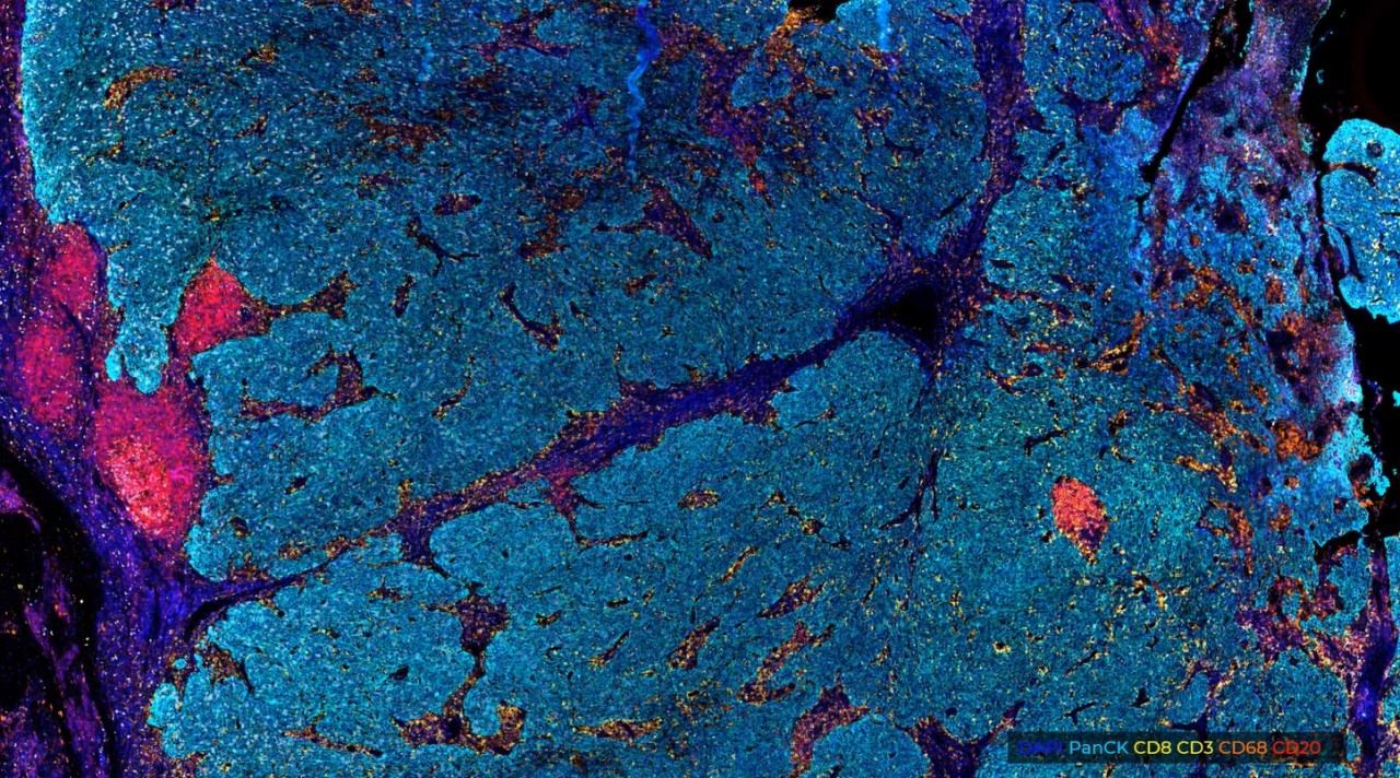 Akoya Biosciences, Inc. on LinkedIn: Tertiary Lymphoid Structures – A ... Akoya Biosciences, Inc. on LinkedIn: Tertiary Lymphoid Structures – A ...