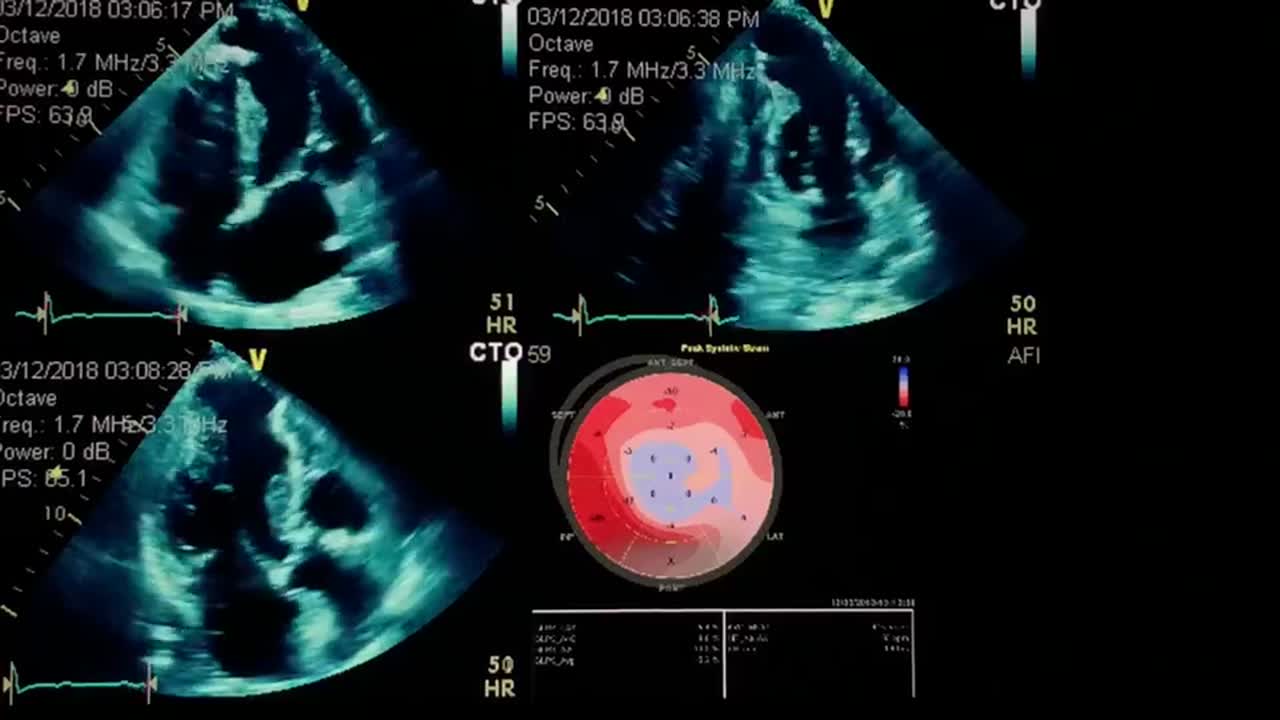 Billy Cathey, RDCS on LinkedIn: LV Apical Aneurysm Billy Cathey, RDCS on LinkedIn: LV Apical Aneurysm