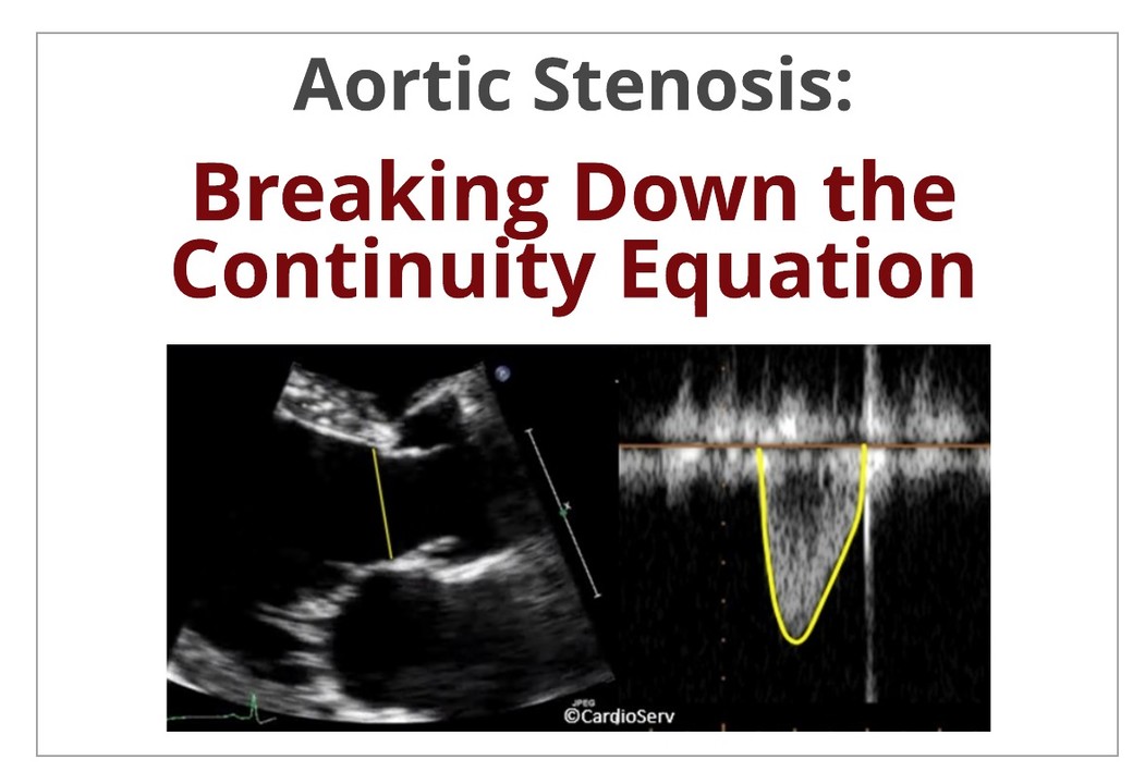 Aortic Stenosis: Breaking Down the Continuity Equation! Aortic Stenosis: Breaking Down the Continuity Equation!