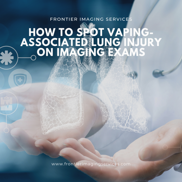 How to Spot Vaping-associated Lung Injury on Imaging Exams How to Spot Vaping-associated Lung Injury on Imaging Exams