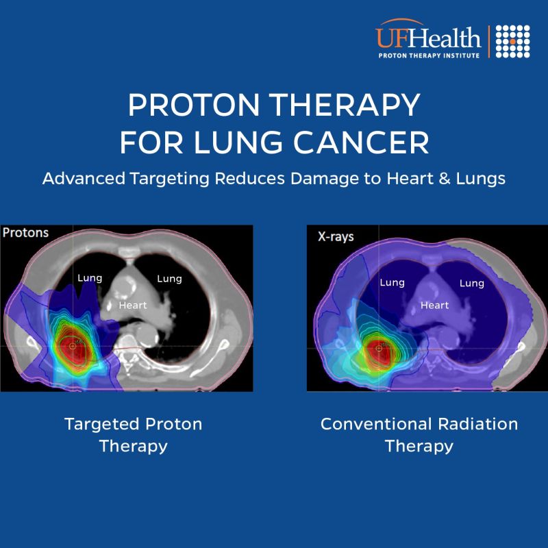 UF Health Proton Therapy Institute on LinkedIn: Proton Therapy for Lung ... UF Health Proton Therapy Institute on LinkedIn: Proton Therapy for Lung ...