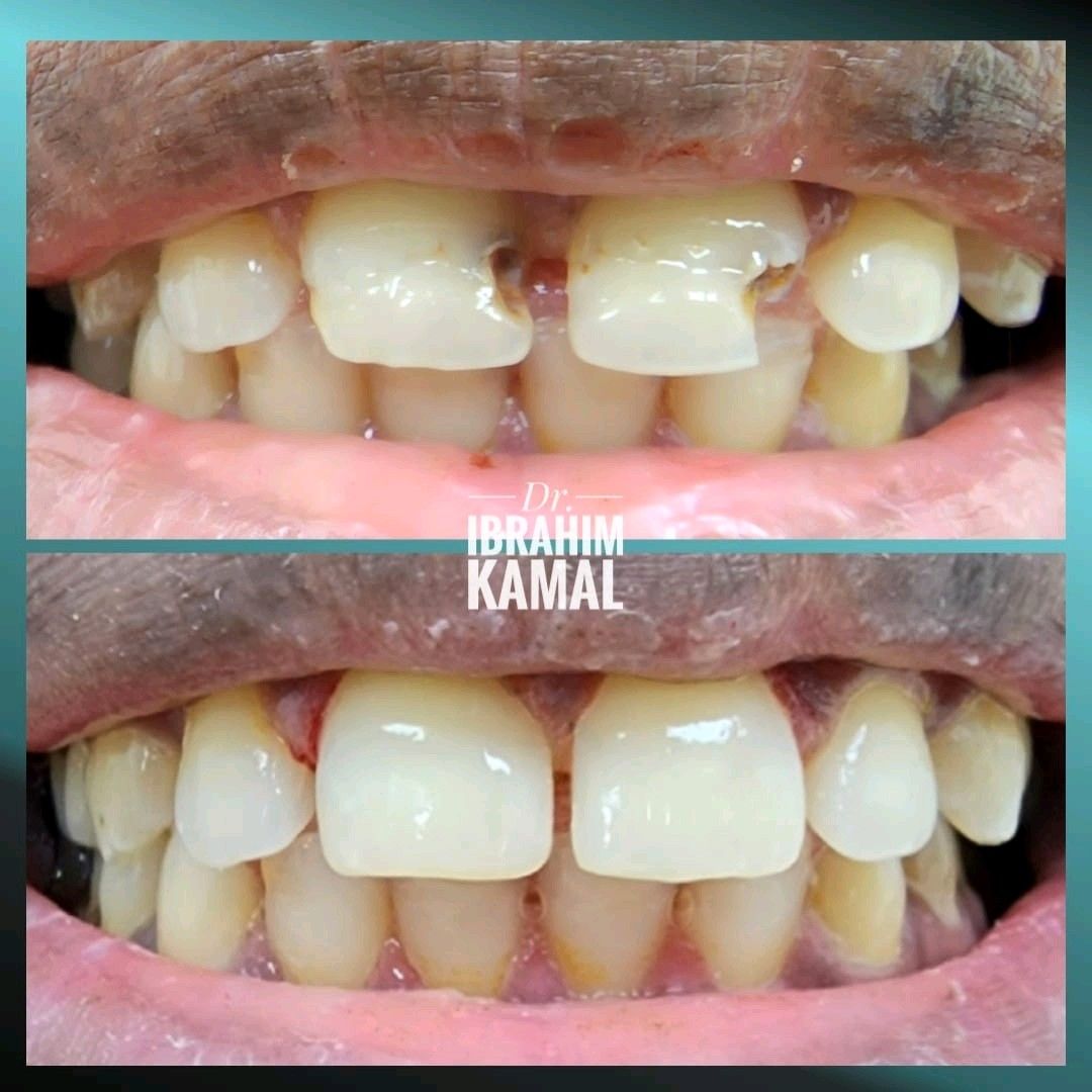 Dr. Ibrahim Kamal on LinkedIn: #dentistry #composites Dr. Ibrahim Kamal on LinkedIn: #dentistry #composites