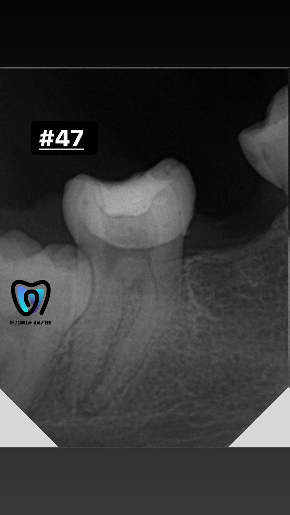 Dr.Abdullah Al-ateeq on LinkedIn: #endodontics #dentist #dental #endo # ... Dr.Abdullah Al-ateeq on LinkedIn: #endodontics #dentist #dental #endo # ...