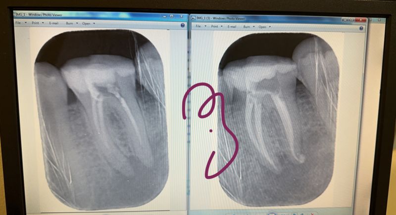 Dr.Abdullah Al-ateeq on LinkedIn: #endodontics #endodontics # ... Dr.Abdullah Al-ateeq on LinkedIn: #endodontics #endodontics # ...