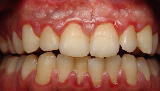 Gum inflammation, gum bleeding, swollen gums Gum inflammation, gum bleeding, swollen gums
