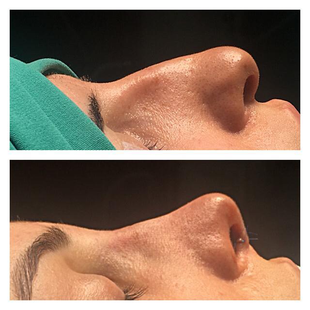 Abdullah AHMED MD on LinkedIn: Removing the hump, rotating the tip and ... Abdullah AHMED MD on LinkedIn: Removing the hump, rotating the tip and ...