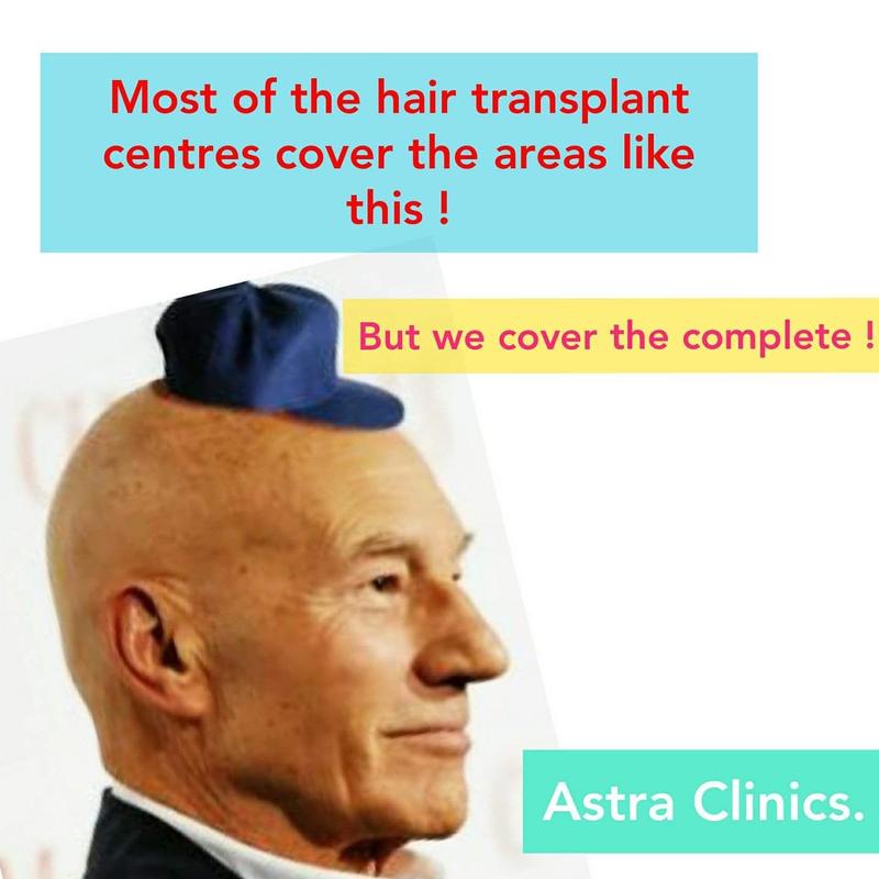 Dr.prawin shinde on LinkedIn: #hairtransplant #astraclinics Dr.prawin shinde on LinkedIn: #hairtransplant #astraclinics