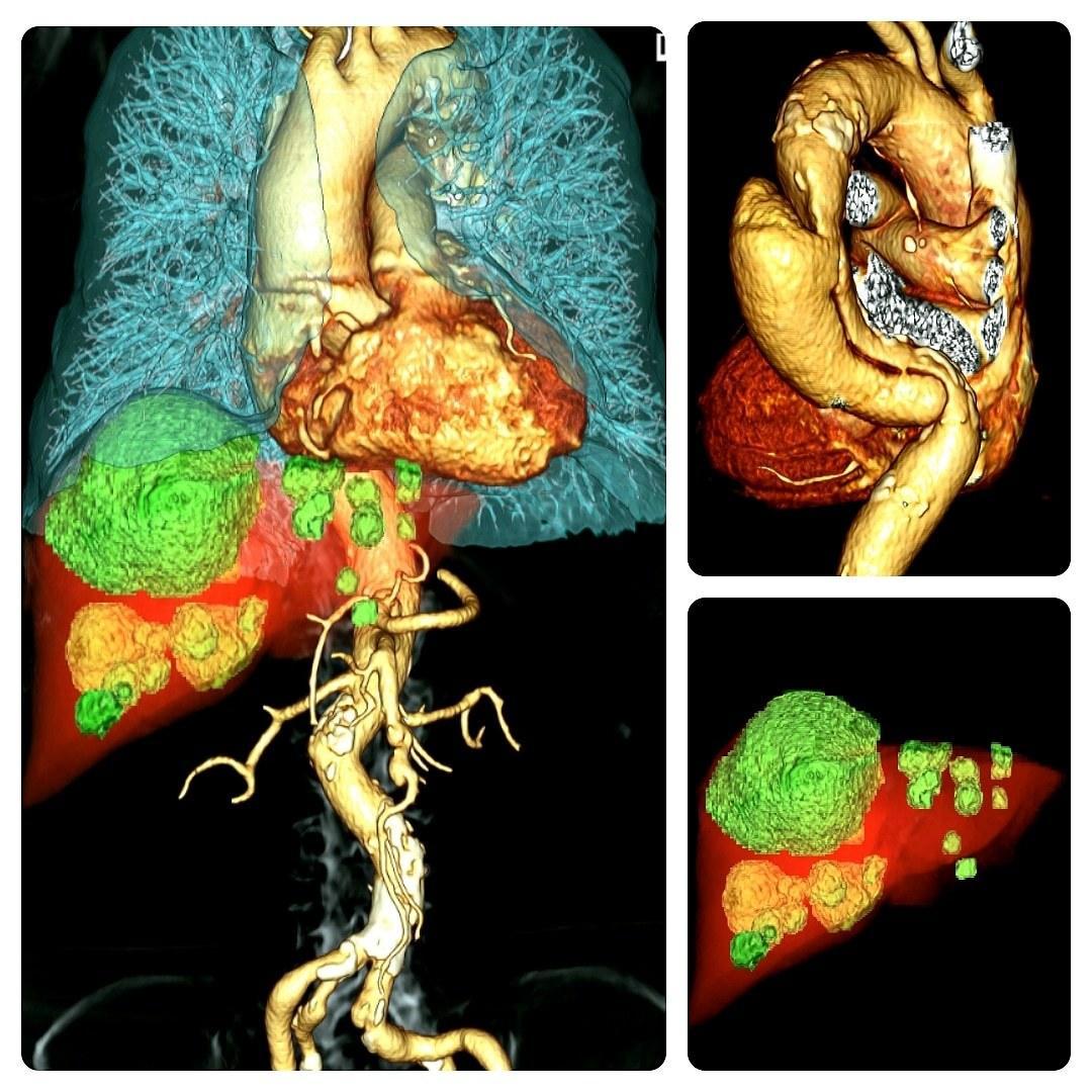 Jesus E. Duque H. on LinkedIn: Paciente con diseccion de aorta toracica ... Jesus E. Duque H. on LinkedIn: Paciente con diseccion de aorta toracica ...