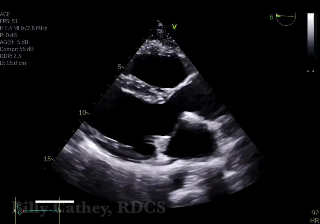 Billy Cathey, RDCS on LinkedIn: This is a textbook congenital heart ... Billy Cathey, RDCS on LinkedIn: This is a textbook congenital heart ...
