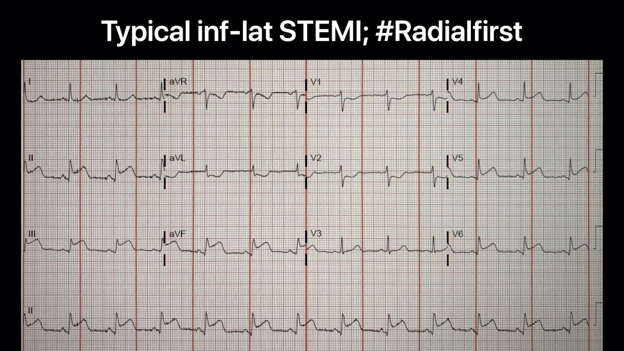 Hady Lichaa, MD, FACC, FSCAI, FSVM, RPVI on LinkedIn: #stemi #coronary ... Hady Lichaa, MD, FACC, FSCAI, FSVM, RPVI on LinkedIn: #stemi #coronary ...