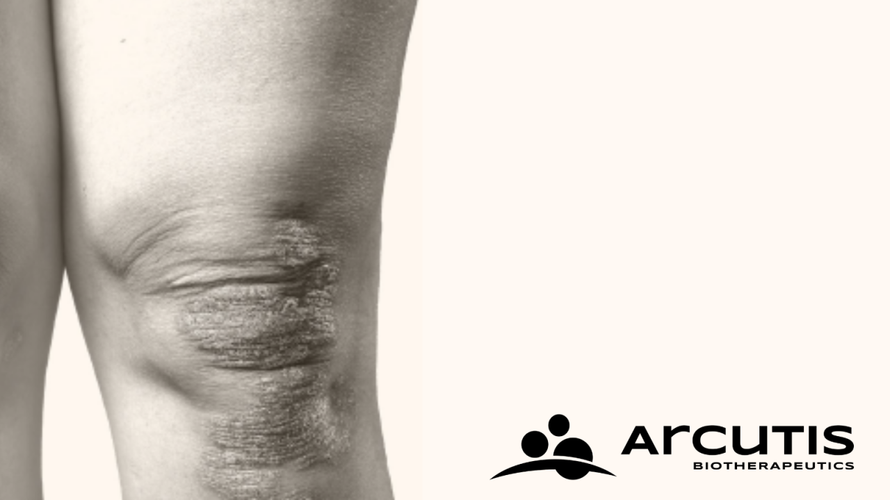 2021 Was a Big Year for Arcutis: FDA accepts New Drug Application for ... 2021 Was a Big Year for Arcutis: FDA accepts New Drug Application for ...