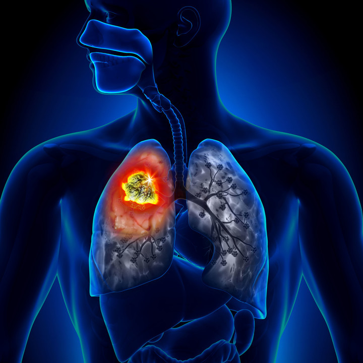 A New Lung Cancer Blood Test – A Promising New Innovation for Early ... A New Lung Cancer Blood Test – A Promising New Innovation for Early ...