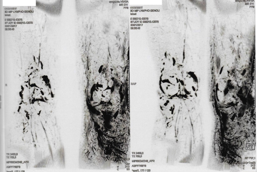 Lymphedema Surgery: Vascularized Lymph Node Transfer Lymphedema Surgery: Vascularized Lymph Node Transfer