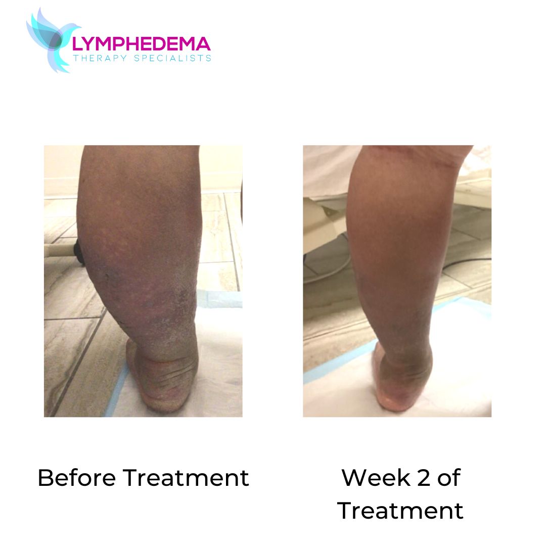Lymphedema Therapy Specialists | Lymphedema Clinic on LinkedIn: # ... Lymphedema Therapy Specialists | Lymphedema Clinic on LinkedIn: # ...