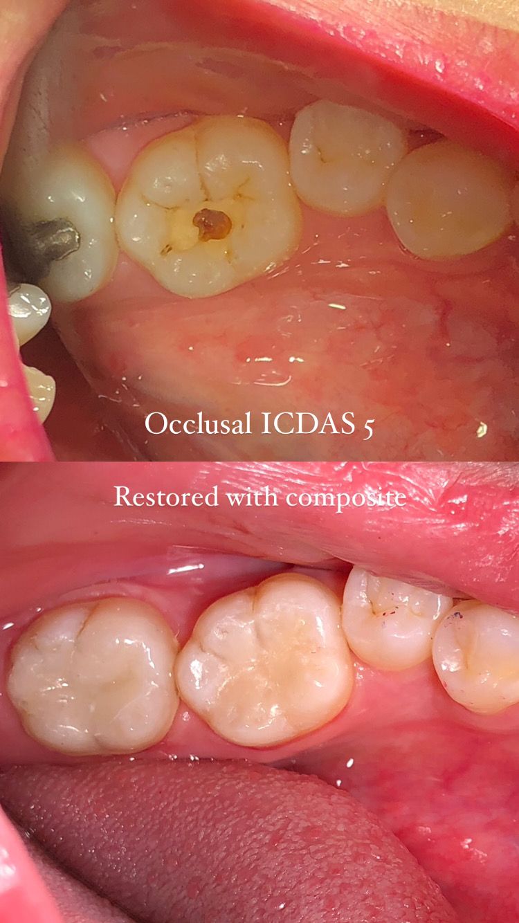 Dr. Nur Alyssa on LinkedIn: Composite filling for occlusal ICDAS 5 on ... Dr. Nur Alyssa on LinkedIn: Composite filling for occlusal ICDAS 5 on ...