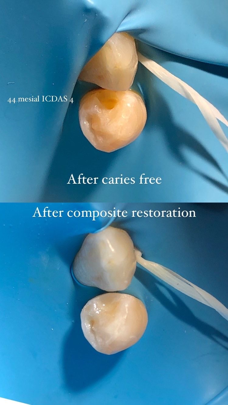 Dr. Nur Alyssa on LinkedIn: Composite restoration class II on 44 and ... Dr. Nur Alyssa on LinkedIn: Composite restoration class II on 44 and ...