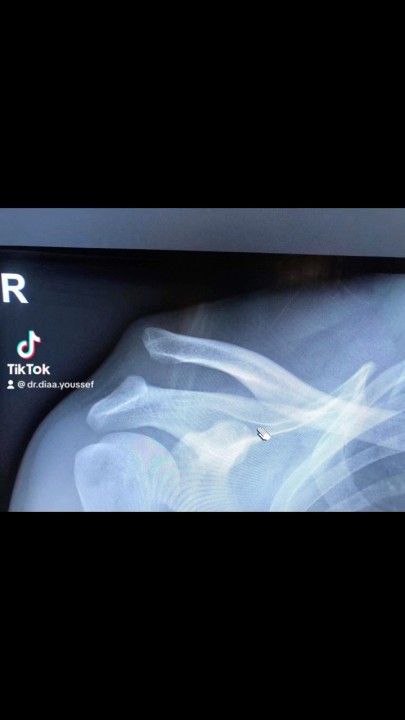 Diaa Youssef, MD, PhD. on LinkedIn: Ac joint dislocation Tightrope used Diaa Youssef, MD, PhD. on LinkedIn: Ac joint dislocation Tightrope used