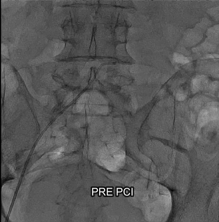 Dr Ankit Gupta on LinkedIn: #interventionalcardiology #cardiologist # ... Dr Ankit Gupta on LinkedIn: #interventionalcardiology #cardiologist # ...