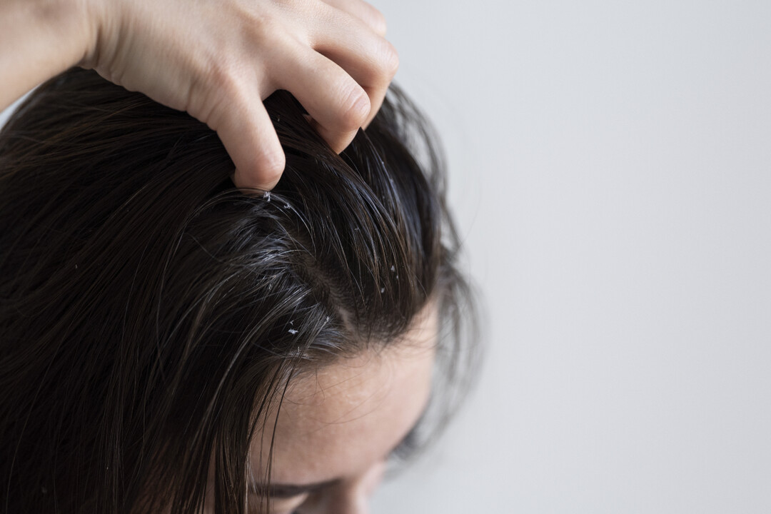 How to Treat Itchy Scalp How to Treat Itchy Scalp