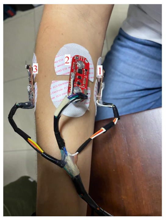 A 3D Printed, Bionic Hand Powered by EMG Signals and Controlled by an ... A 3D Printed, Bionic Hand Powered by EMG Signals and Controlled by an ...