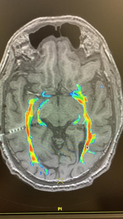 Should we try tDCS and cognitive exercise to treat Negative Signs of ... Should we try tDCS and cognitive exercise to treat Negative Signs of ...