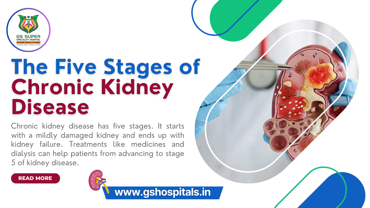 The Five Stages of Chronic Kidney Disease The Five Stages of Chronic Kidney Disease