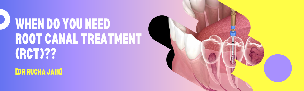 Demystifying Root Canal Treatment: Understanding the Need, Procedure ... Demystifying Root Canal Treatment: Understanding the Need, Procedure ...