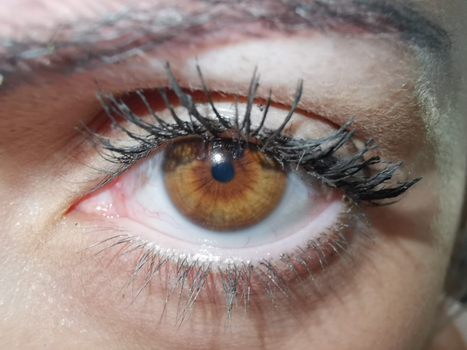 MYLumineyes eye color change laser on LinkedIn: Change in eye color ... MYLumineyes eye color change laser on LinkedIn: Change in eye color ...