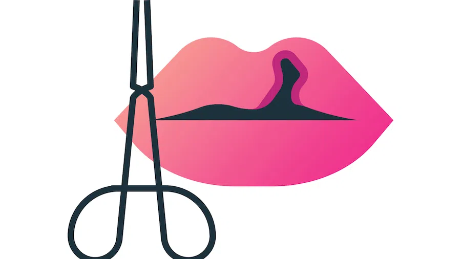 Cleft Lip and Palate: Causes, Genetics, Inheritance, And Outlook Cleft Lip and Palate: Causes, Genetics, Inheritance, And Outlook