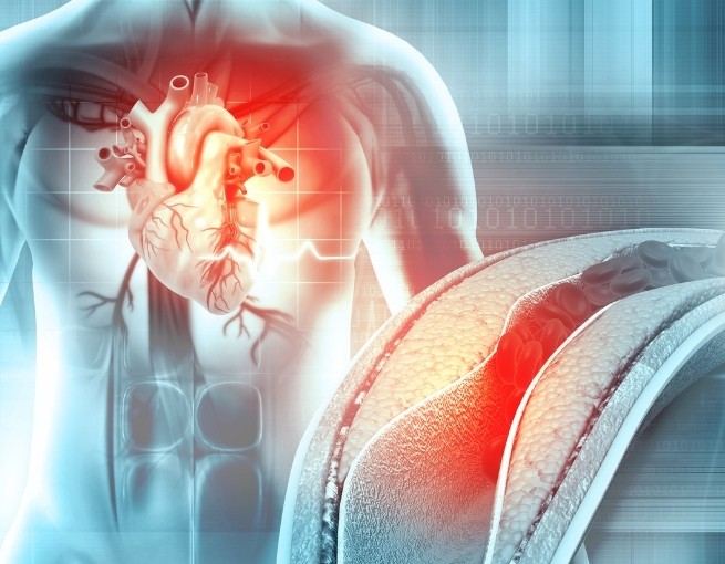 Impact of Bempedoic acid on LDL-C reduction and cardiovascul Impact of Bempedoic acid on LDL-C reduction and cardiovascul