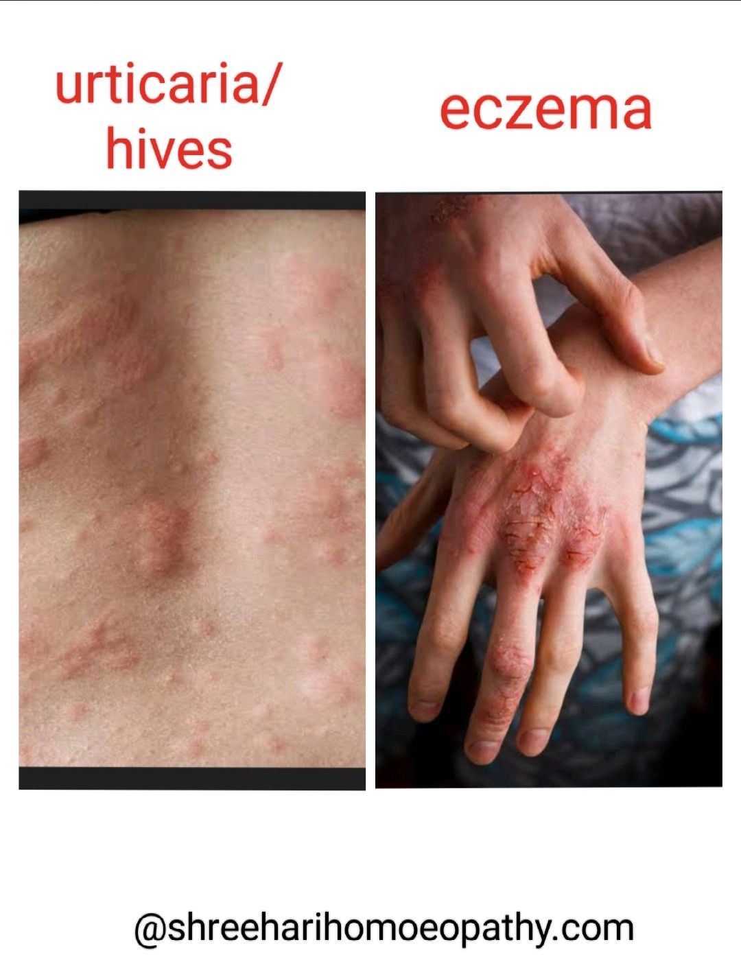 Seema Verma on LinkedIn: Description: Difference between urticaria and ... Seema Verma on LinkedIn: Description: Difference between urticaria and ...