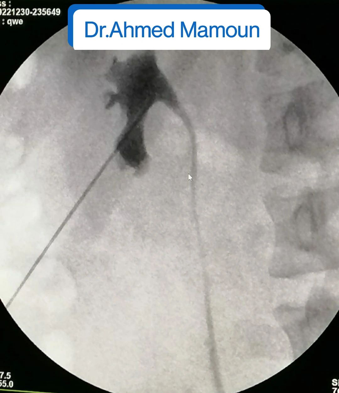 Ahmed Maamoon Mohamed Ali on LinkedIn: #ir_urology #percutaneous ... Ahmed Maamoon Mohamed Ali on LinkedIn: #ir_urology #percutaneous ...