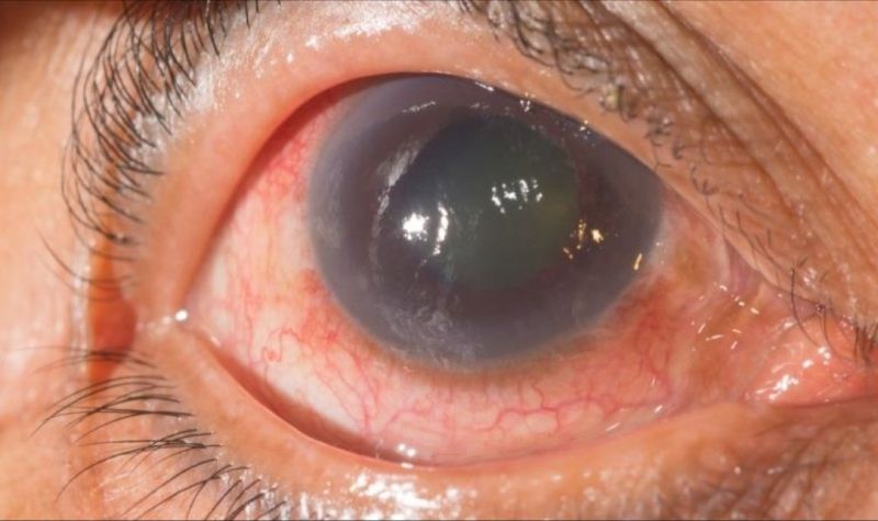 Doreen Tachie-Donkor on LinkedIn: #glaucomaawareness Doreen Tachie-Donkor on LinkedIn: #glaucomaawareness