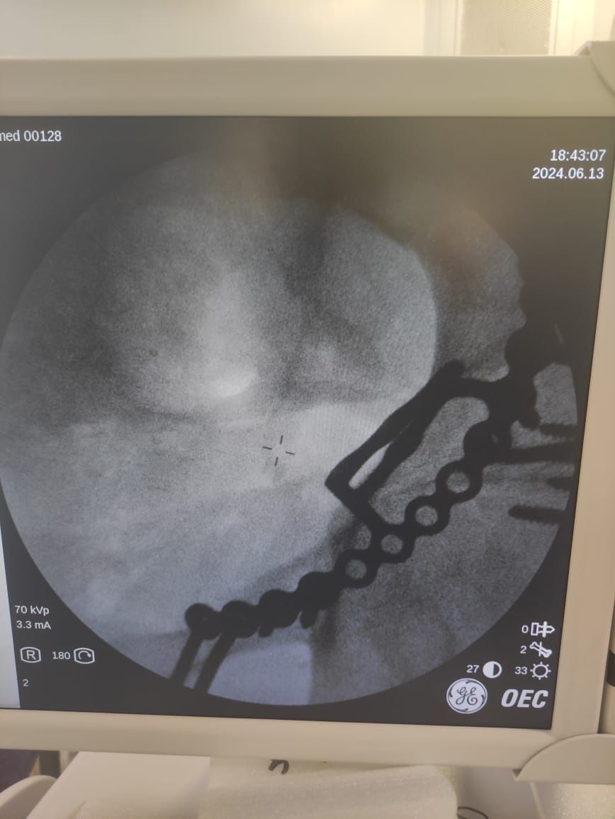 Dr Muhammad Haseeb on LinkedIn: #ortho Dr Muhammad Haseeb on LinkedIn: #ortho