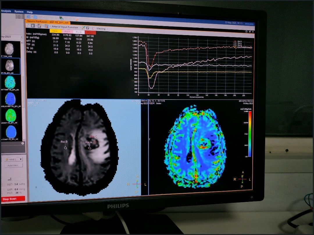 Ritwik Biswas on LinkedIn: T2*W Neuroperfusion. Also known as DSC ... Ritwik Biswas on LinkedIn: T2*W Neuroperfusion. Also known as DSC ...