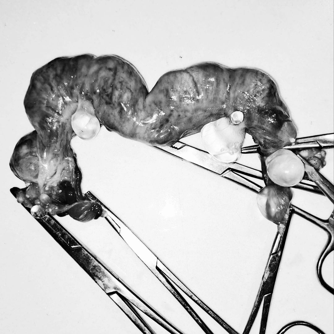 Aoun Raza on LinkedIn: #cysticovariananduterinesyndrome #nymphomania # ... Aoun Raza on LinkedIn: #cysticovariananduterinesyndrome #nymphomania # ...