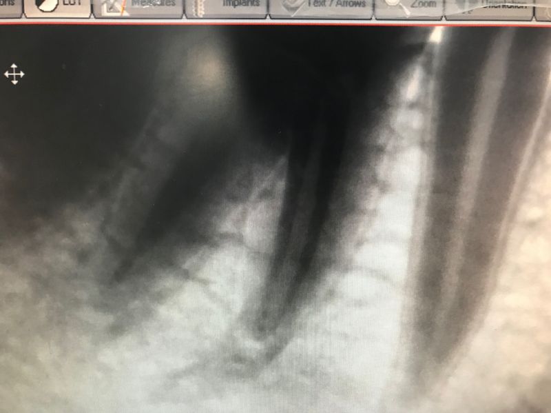Urooj Khan on LinkedIn: #endodontics #routine Urooj Khan on LinkedIn: #endodontics #routine