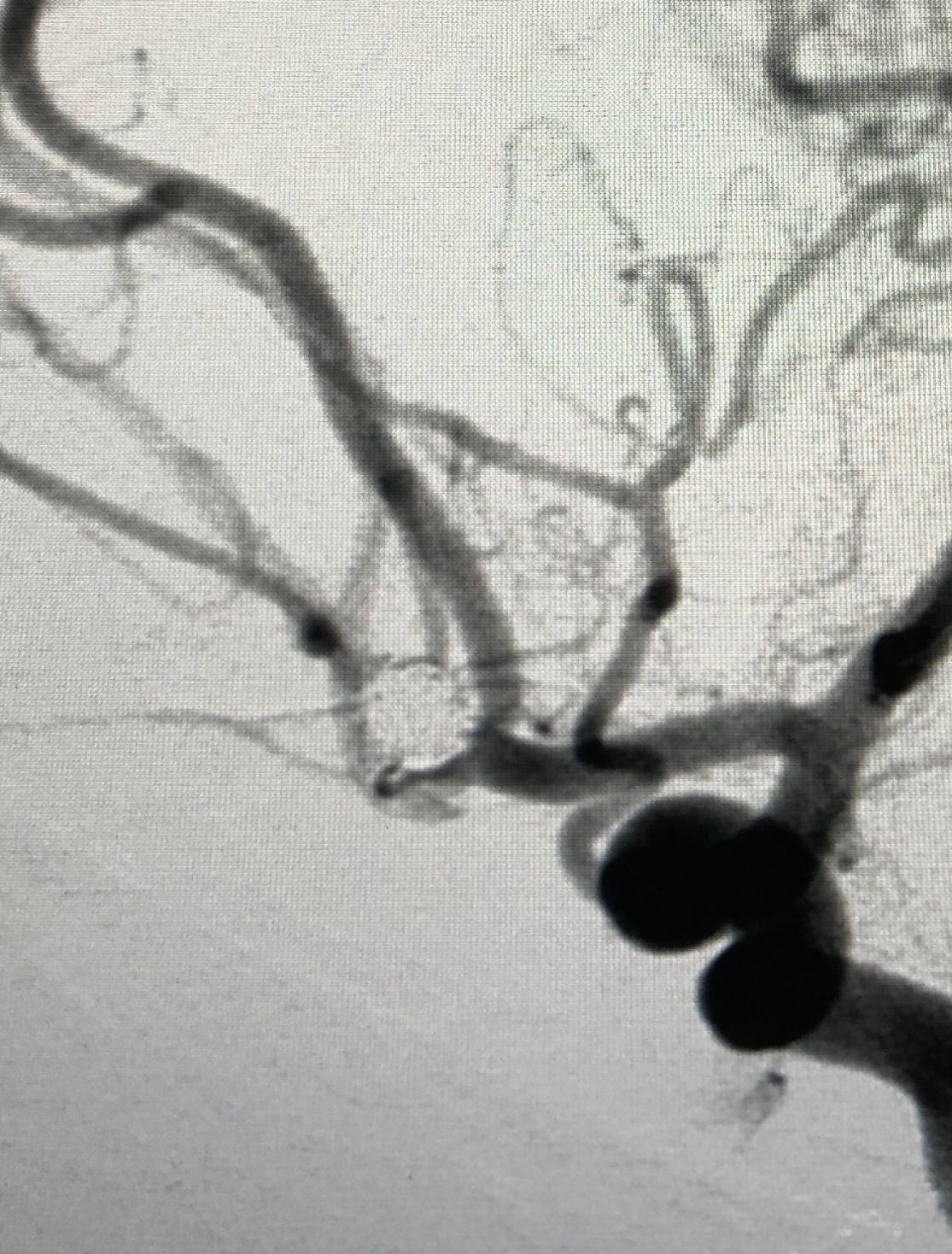 Carlos E. Baccin, MD on LinkedIn: 9 years DSA follow up ( Acom and mca ... Carlos E. Baccin, MD on LinkedIn: 9 years DSA follow up ( Acom and mca ...